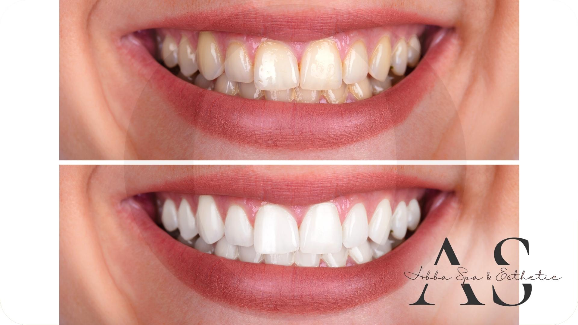 Abba Spa & Esthetic - Separa con $12: 1 Sesión de Blanqueamiento Dental ...